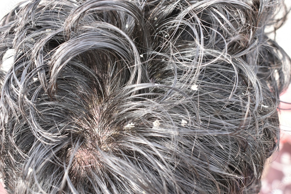 Men's hair is a top view close-up with Gray hair and Dandruff Stock ...