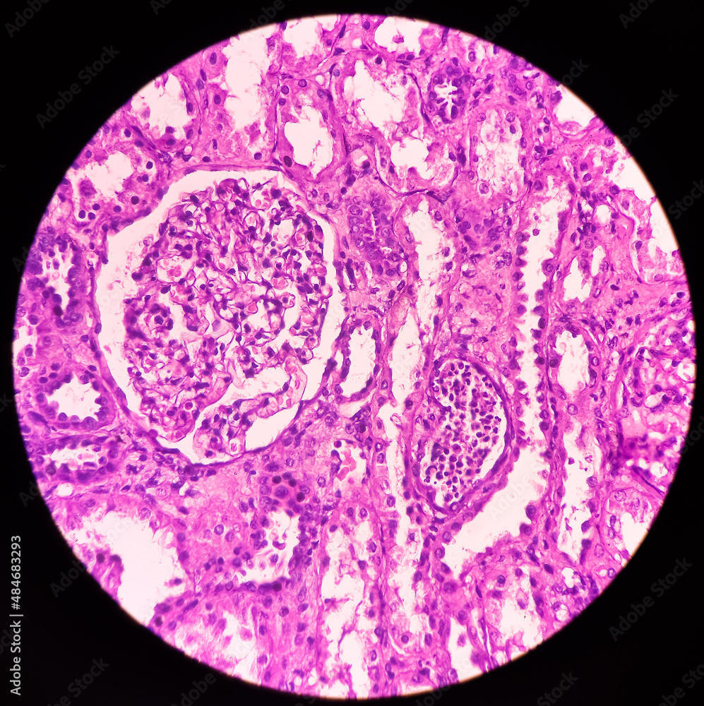 Kidney cancer: Show malignant neoplasm, clear cell carcinoma, fuhrman ...