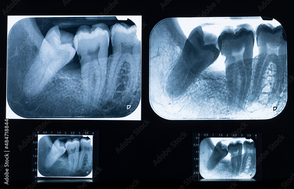 Detailed X-ray scan with impacted wisdom teeth issue Stock Photo ...