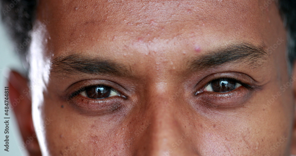 Depressed Eyes