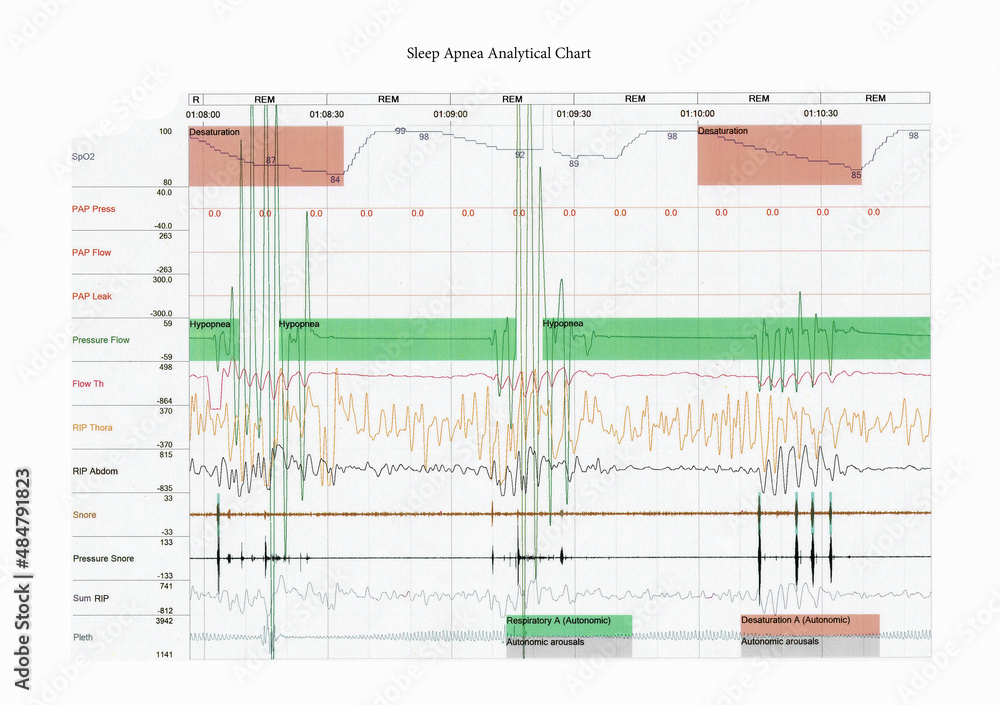 Obstructive Sleep Apnea Symptom Chart From Sleep Test For Doctor To Analytics Of Breathing