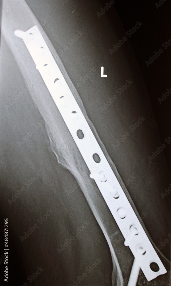 Plain X ray on the left femur that shows united mid shaft left femur ...