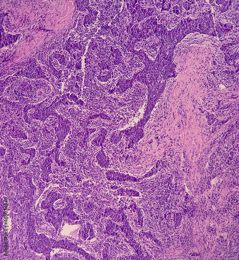Nasopharyngeal carcinoma, nasopharynx cancer, microscopic show ...