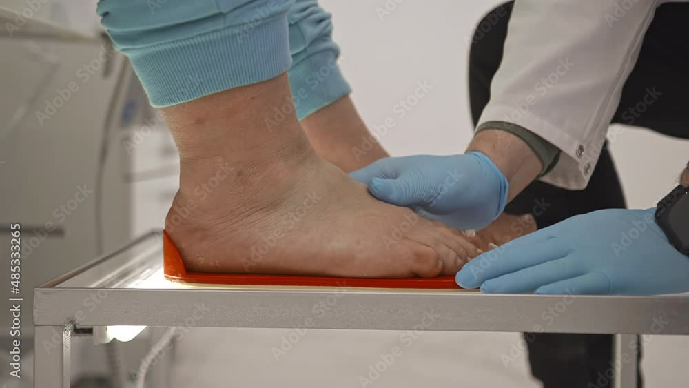 Vidéo Stock A podiatrist orthopedist tries on a patient with flat feet ...