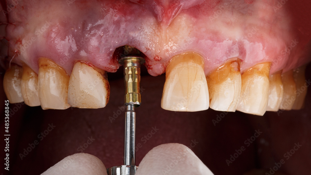 installation of an individual abutment after dental implantation of the ...