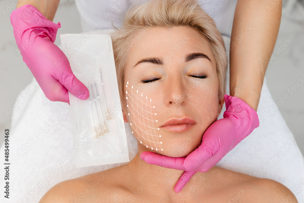 Woman's face with arrows on a cosmetology procedure of thread lifting ...