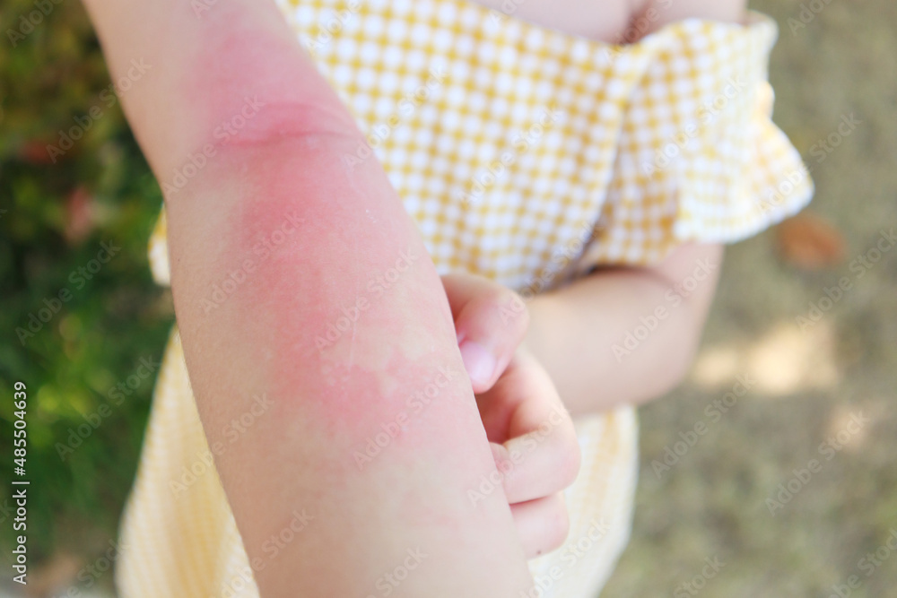 Little girl has skin rash allergy and itchy on her arm Stock Photo ...