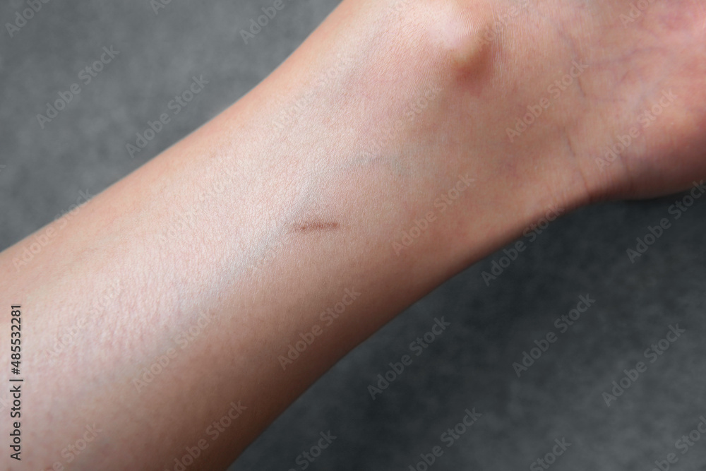 Closeup focus red scar raised line visible mark on woman’s leg with ...