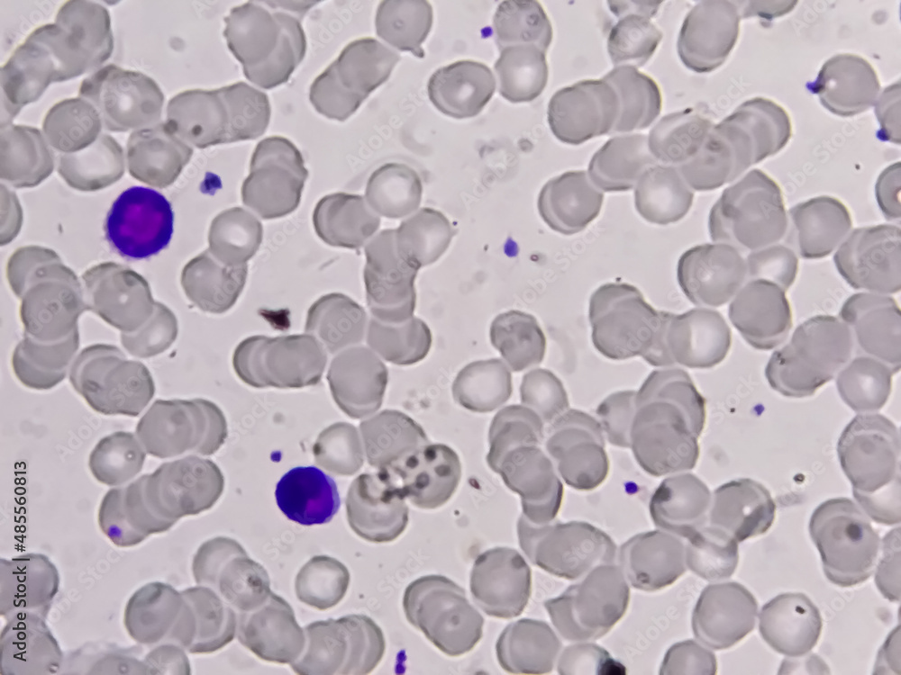 Photo & Art Print Blood smear microscopic show Reactive lymphocytes and ...