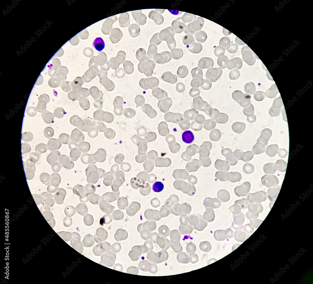 Blood smear microscopic show Reactive lymphocytes and Neutropenia ...