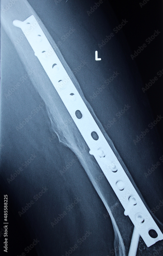 Plain X ray on the left femur that shows united mid shaft left femur ...