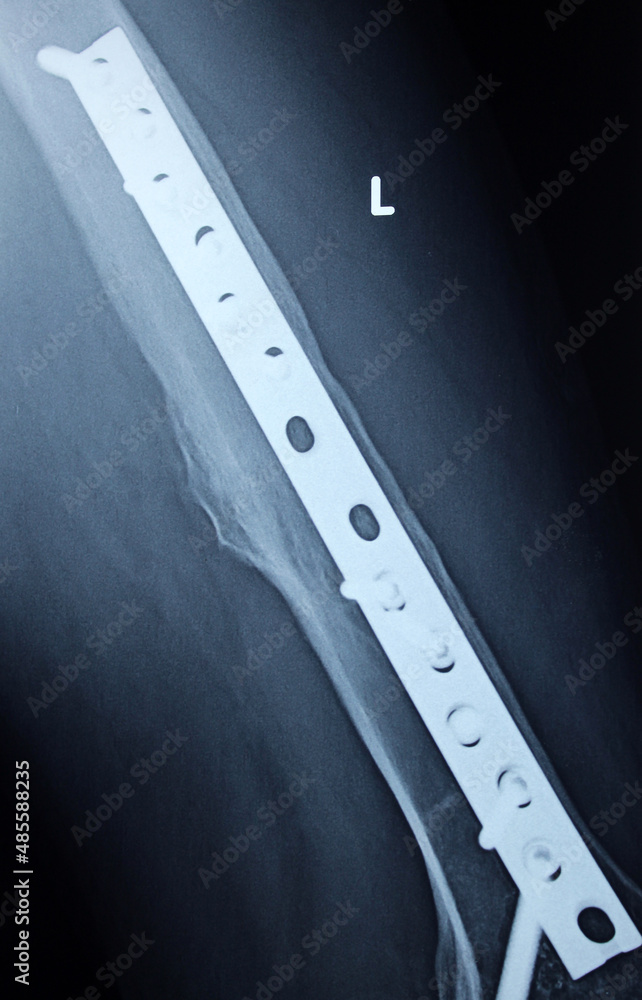 Plain X ray on the left femur that shows united mid shaft left femur ...