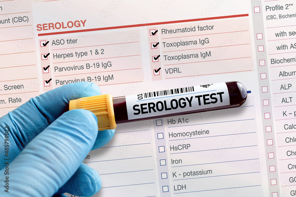 Blood tube test with requisition report for Serology test. Blood sample ...