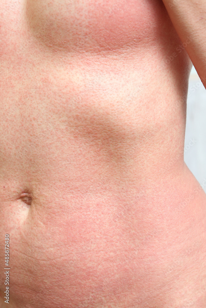 Hives (urticaria): skin rash with red, raised, itchy bumps. Skin ...