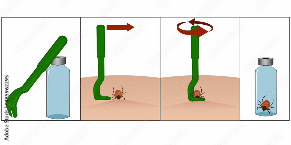 Illustration of special tweezers for removing ticks. Instructions for ...