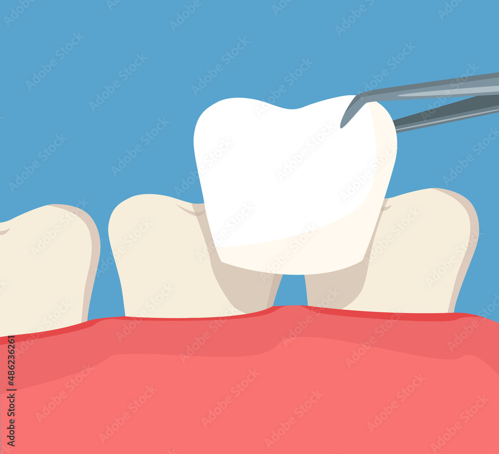 Tooth restoration. Installing a new veneer on a discolored tooth ...