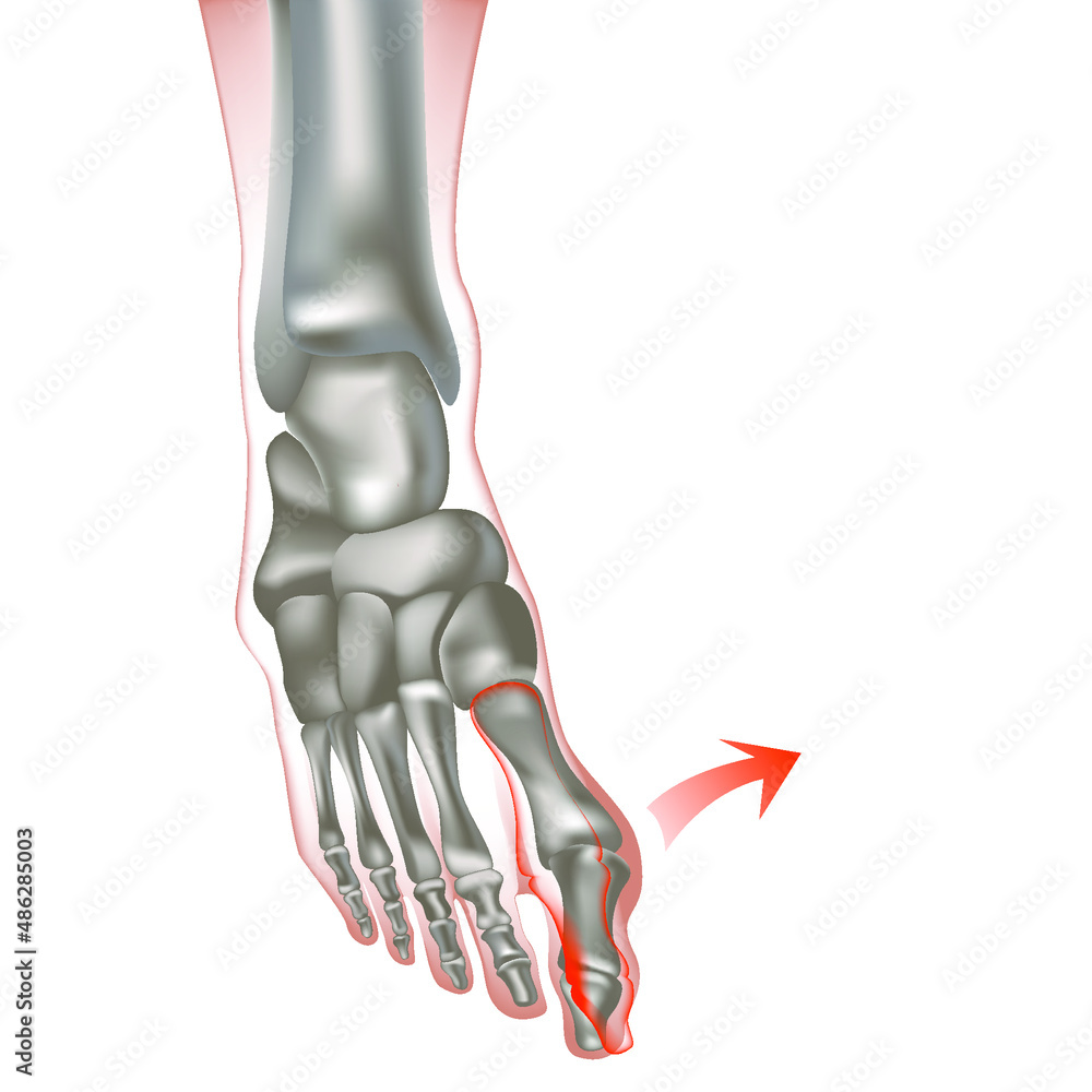 Valgus deformity of the big toe. Bones on the feet or bumps on the feet ...