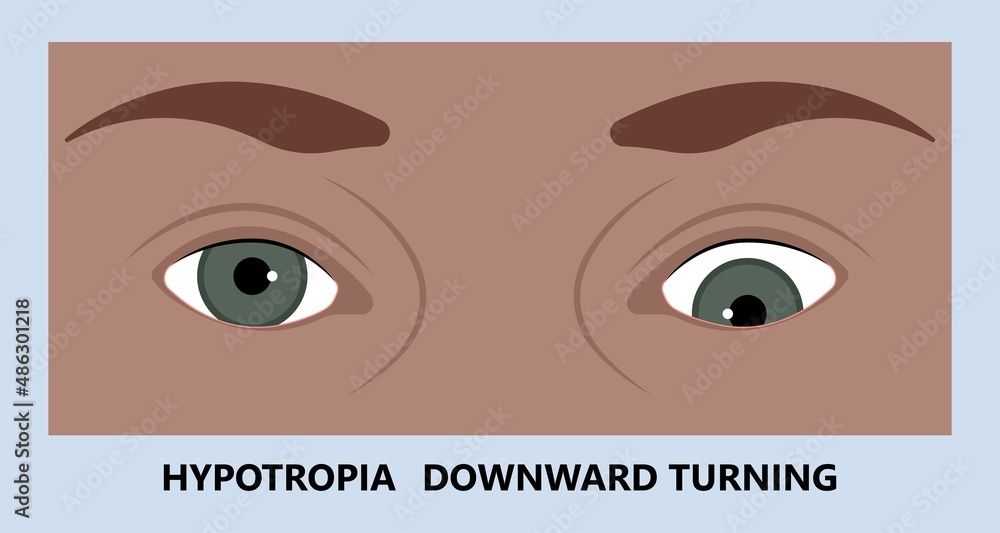Diplopia Double Vision Test Exam Brain Nerve Dry Eye Palsy Gravis Diplopia Double Vision Test Exam Brain Nerve Dry Eye Palsy Gravis