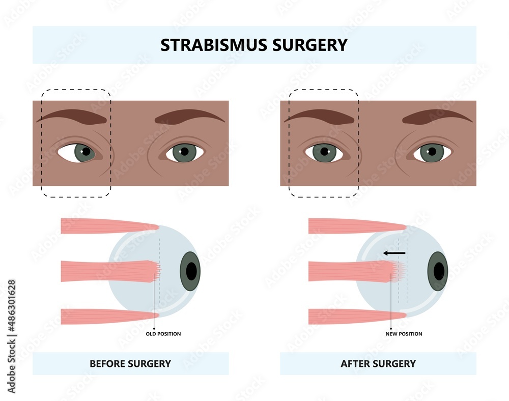 Diplopia double vision test exam brain nerve dry eye palsy gravis ...