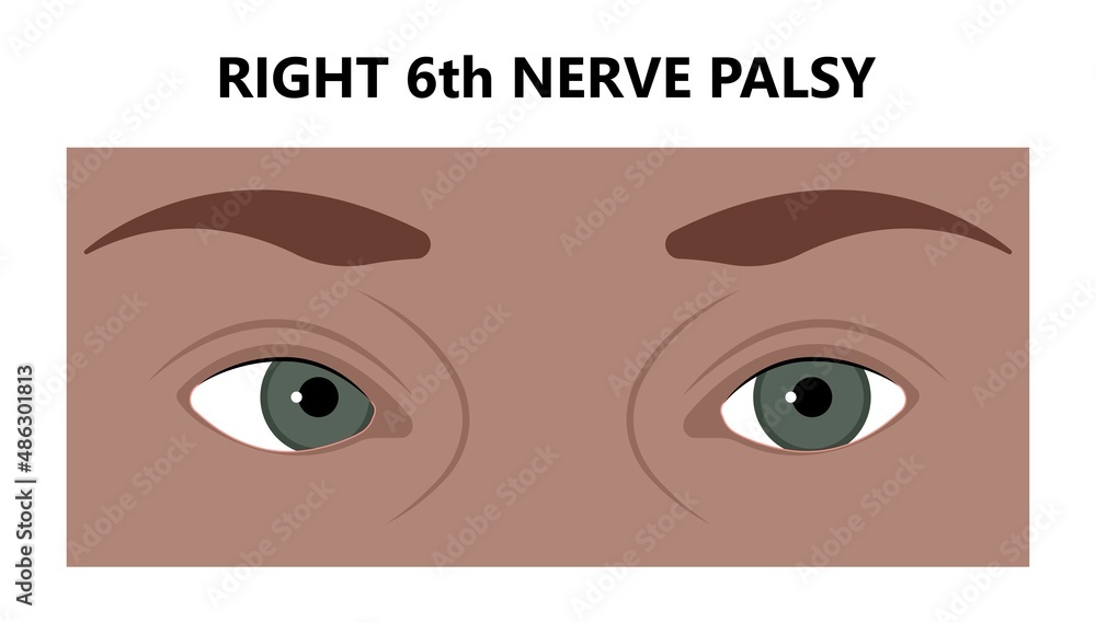 Diplopia double vision test exam brain nerve dry eye palsy gravis ...
