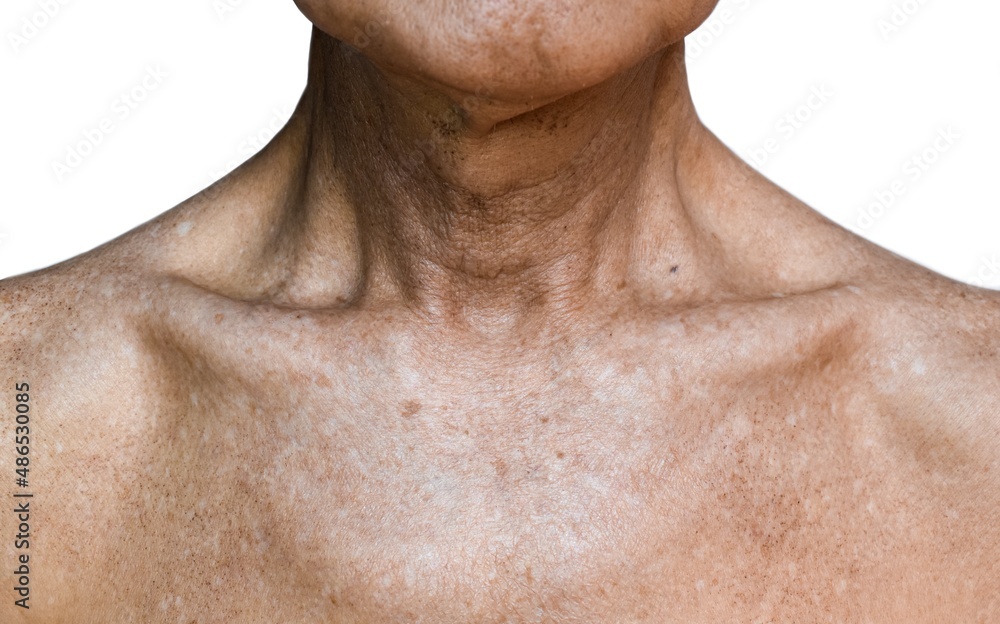 Aging and wrinkled skin at chest of Asian, Chinese old man. Stock Photo ...