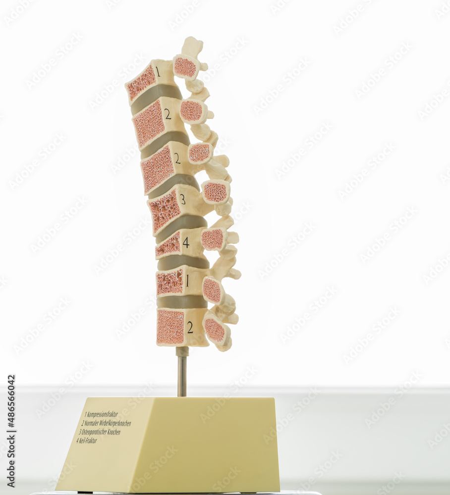 A model of the human spine that shows various defects in the bones and ...
