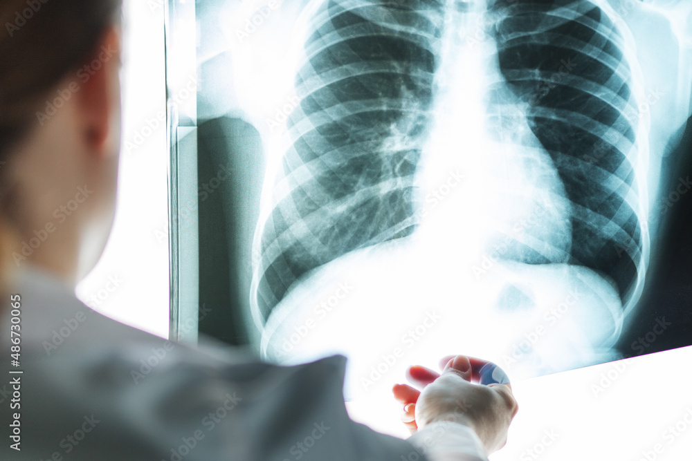 Bronchitis X Ray