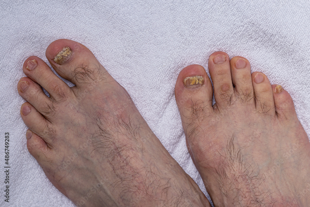 Feet of a man close-up of fingers affected by a fungal nail plate. Ugly ...