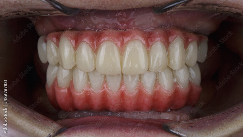 upper and lower jaw prostheses with artificial gums in the oral cavity ...