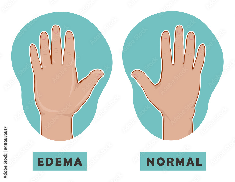 Swollen hand and normal hand. Edema and lymphedema. Vector illustration ...