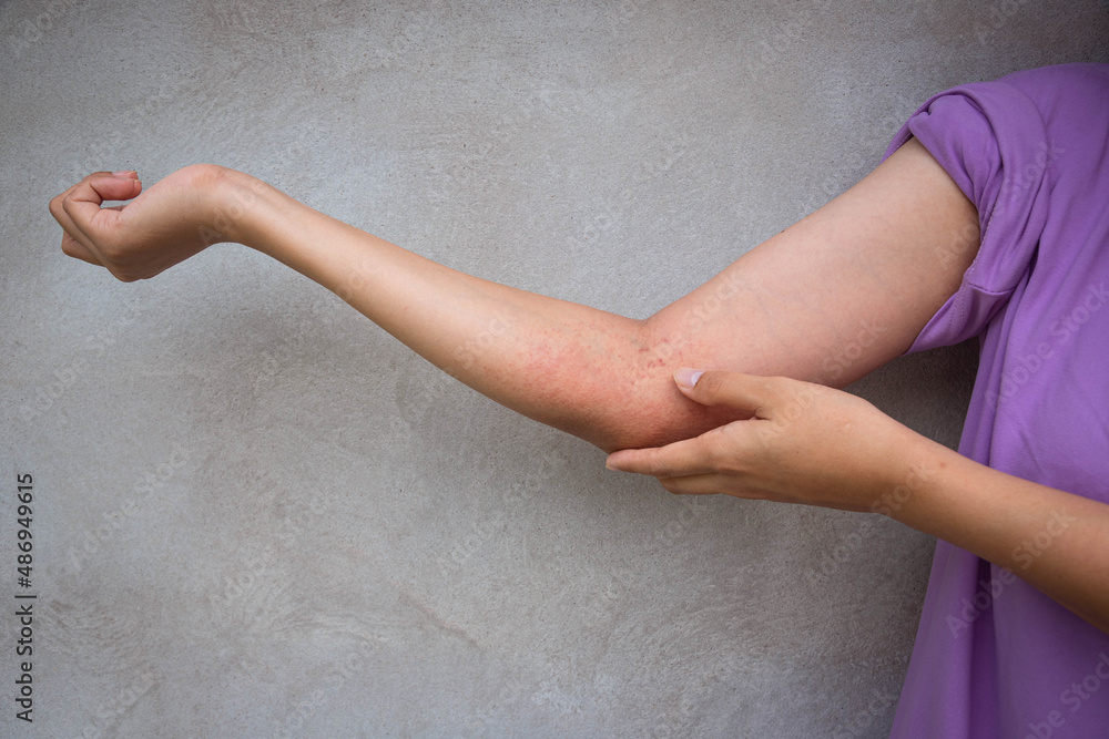 itchy rash on woman's arm Stock Photo | Adobe Stock