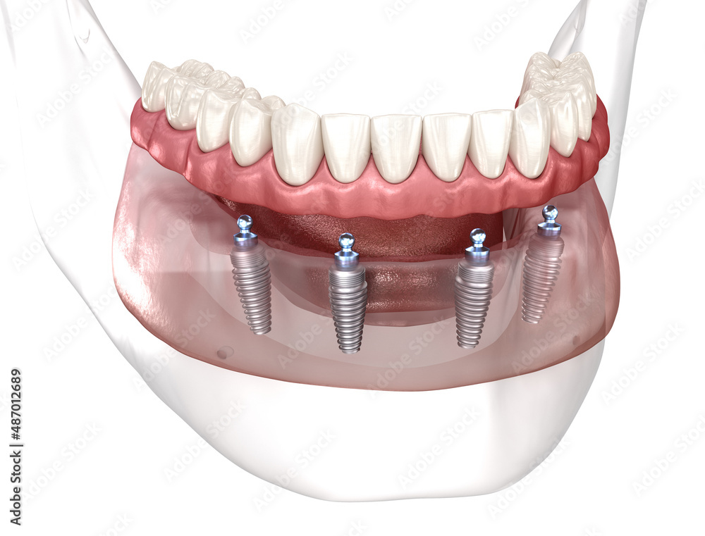 Removable mandibular prosthesis All on 4 system supported by implants ...