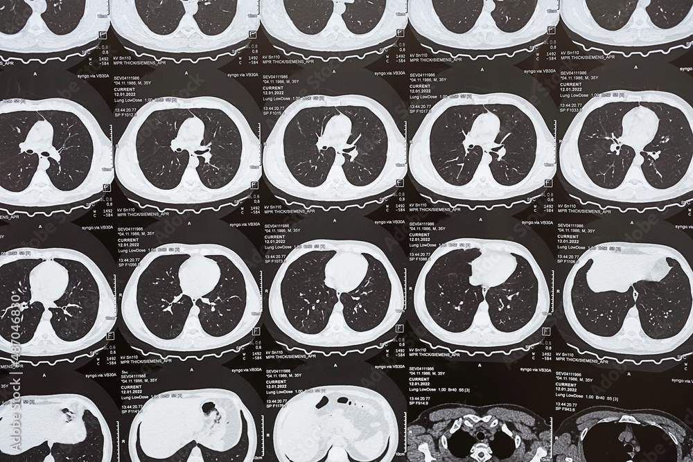 Computed tomography of the lungs, selective focus. Chest CT scan with ...