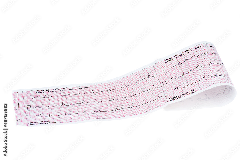 Echocardiogram (ECG) showing abnormal heart rhythm. Stock Photo | Adobe ...