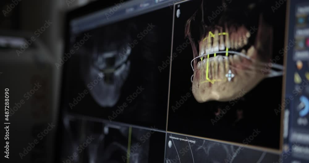 MRI of the jaw in a modern dental clinic. MRI image on a patient's x ...