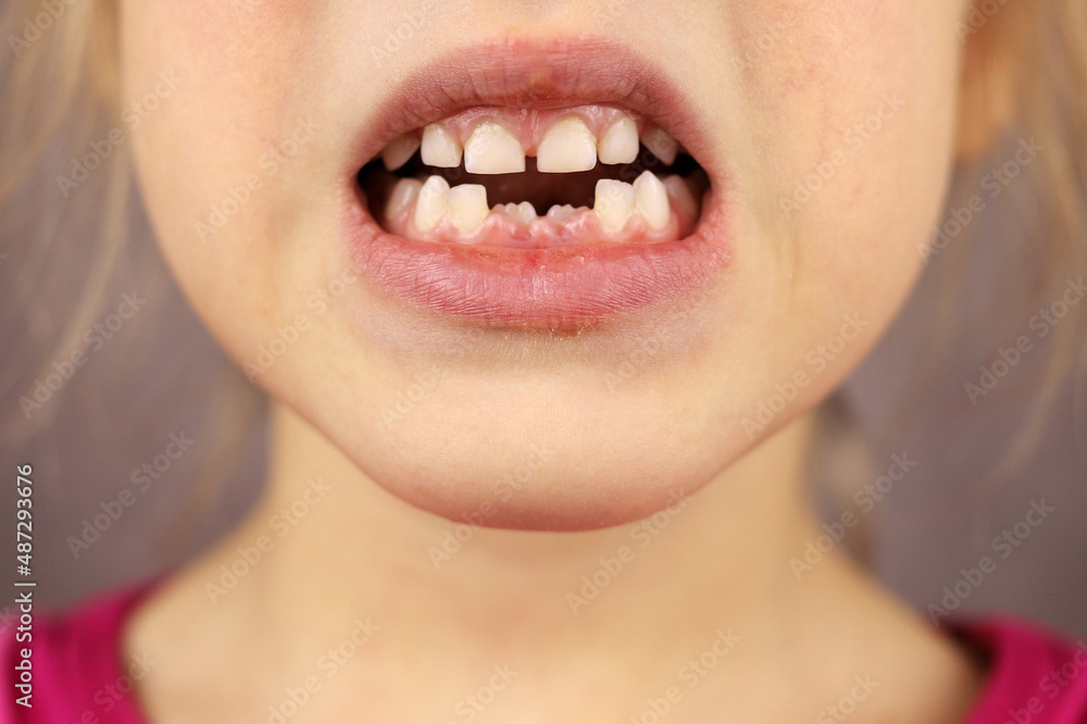 child's mouth without two front teeth, loss of baby teeth Stock Photo ...