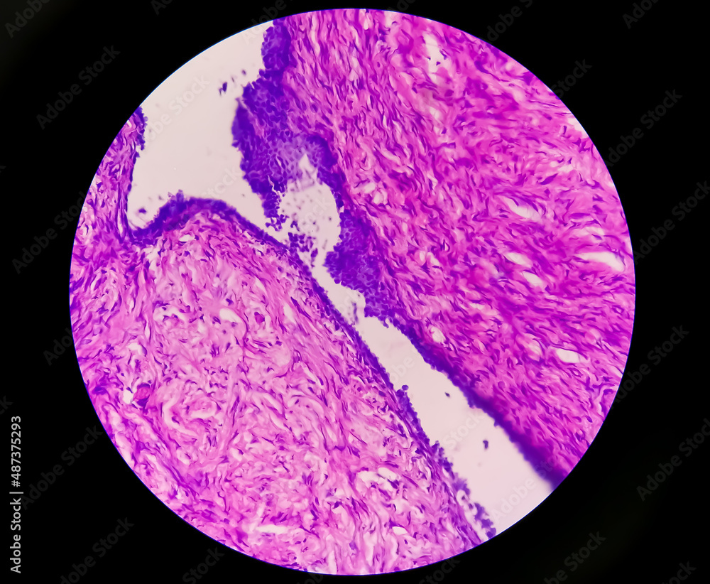Ovarian cyst, Serous cyst adenofibroma, relatively rare benign ovarian ...