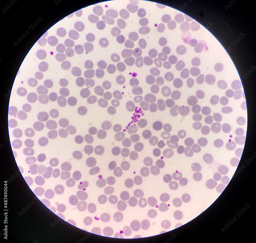 Platelet clumping in smear CBC on red blood cells background. Stock ...