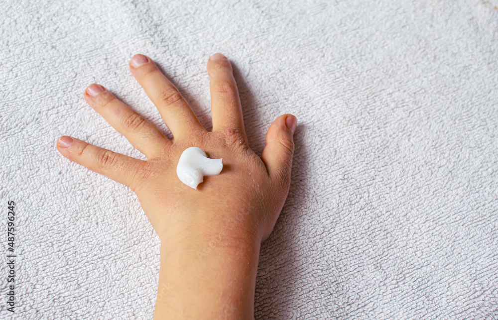 Red spots on the skin of the child's hands.children's allergy.selective ...