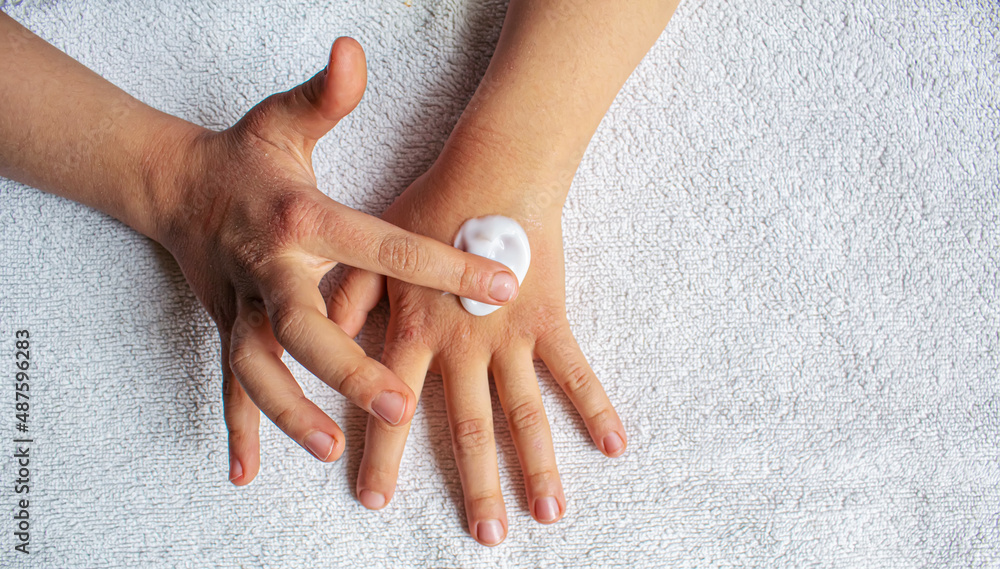 Red spots on the skin of the child's hands.children's allergy.selective ...