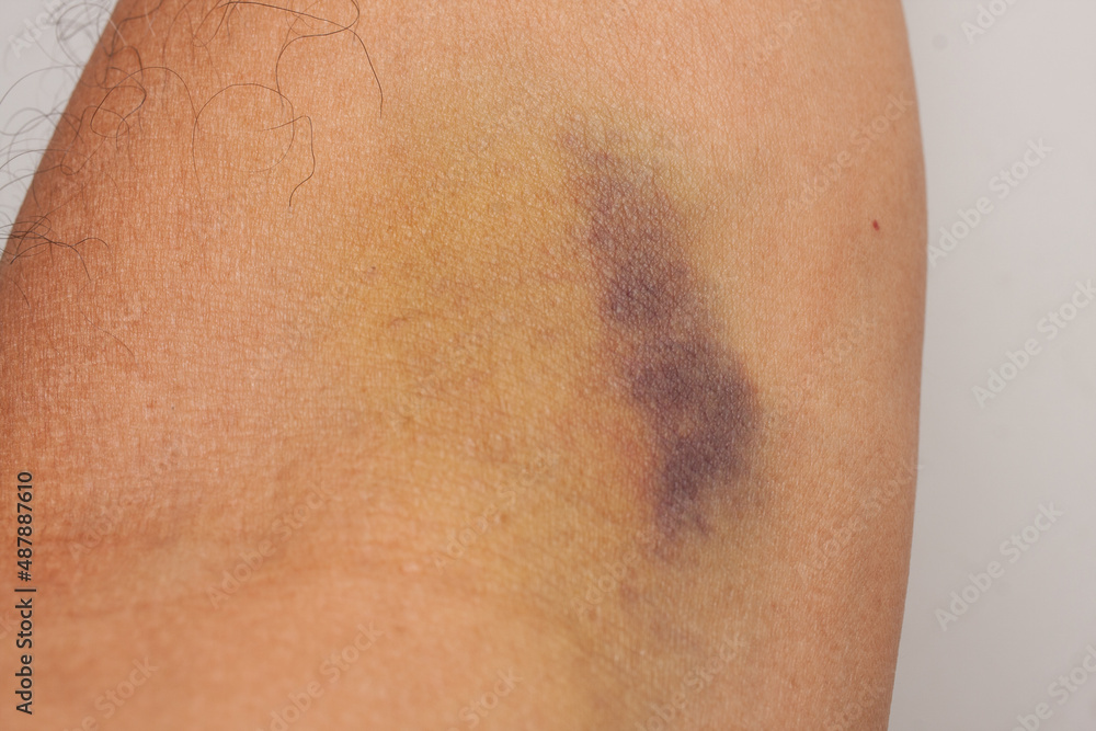 Man with a Big Bruise on his Arm from an I V or Intravenous Drip Stock ...