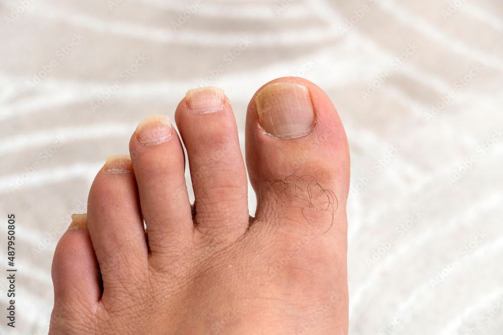 cutting toenails,a person toenails growing too long,extended toenails ...