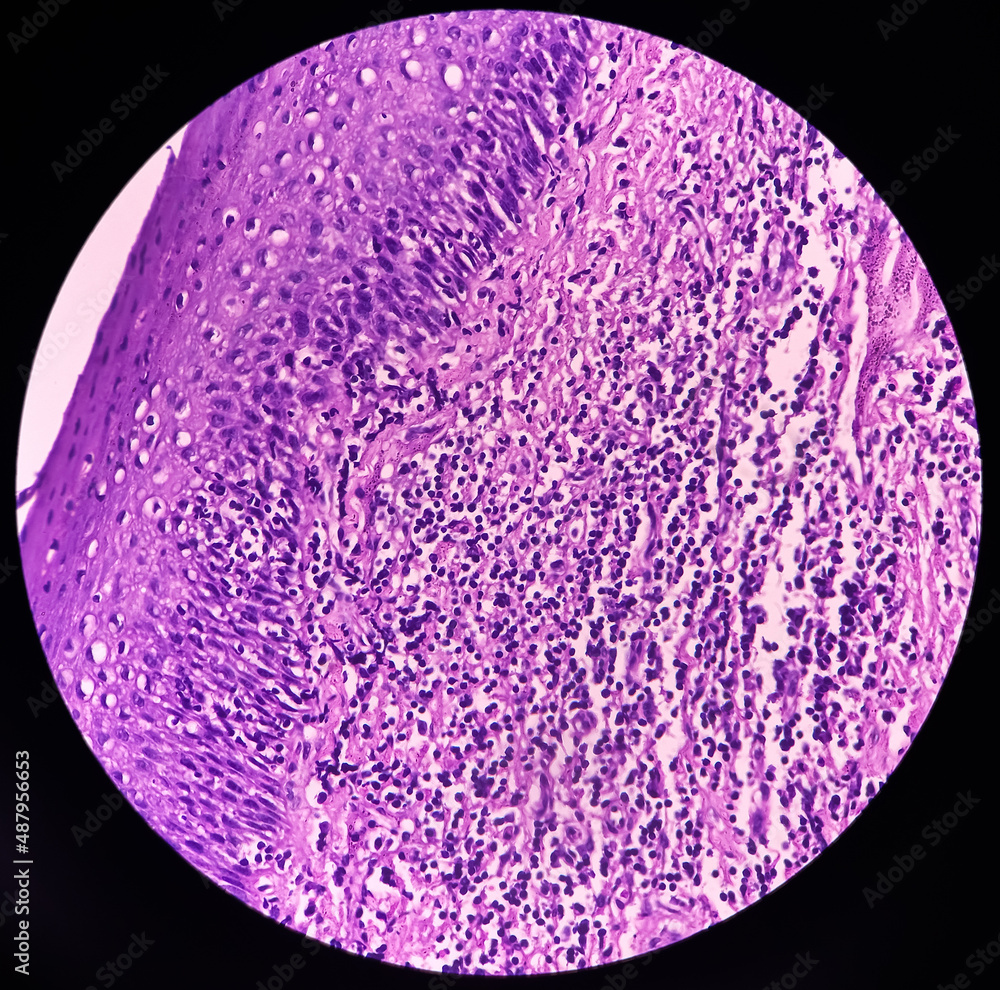 Chronic tonsillitis: Microscopic image of tonsillar tissue, show ...