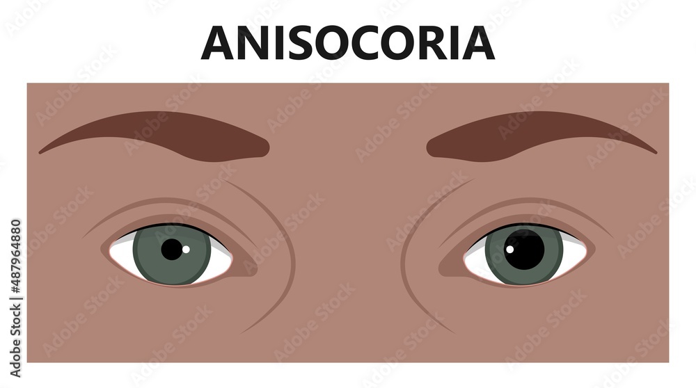 Plakat miosis eye pupil size iris retina brain Horner miotic muscle ...