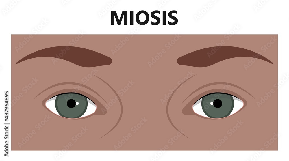 miosis eye pupil size iris retina brain Horner miotic muscle dilated ...