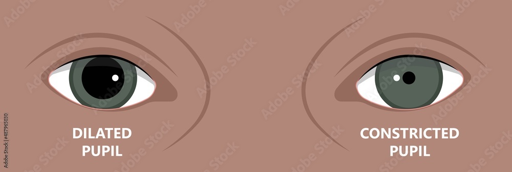 Stockvector miosis eye pupil size iris retina brain Horner miotic ...