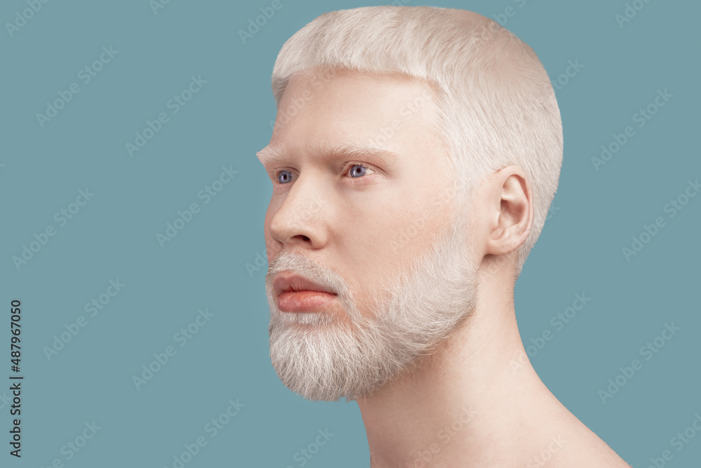 Albinism concept. Albino guy with pale skin and white hair looking ...