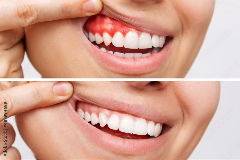 Two shots of a young woman with red bleeding gums and health gums ...
