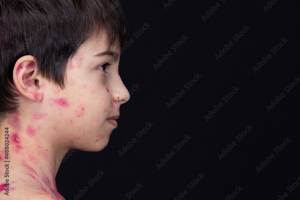 Close-up of cute little children. Chickenpox virus or vesicular rash on ...