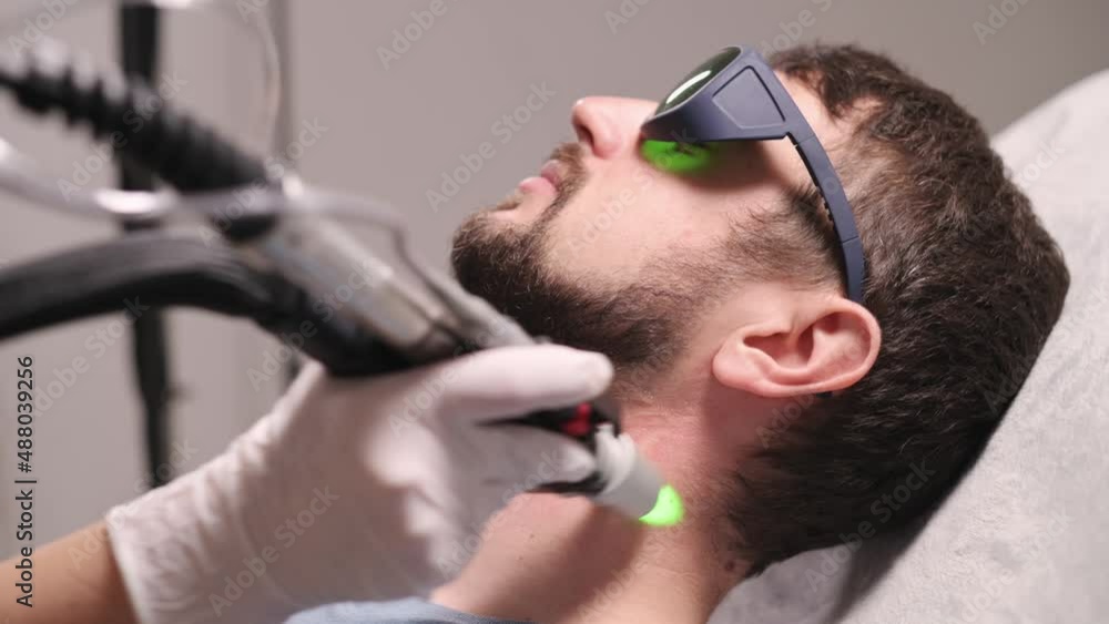 Laser depilation of beard contour. Man getting permanent laser face ...